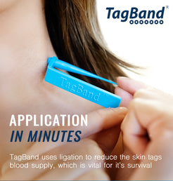 TagBand Skin Tag Remover Kit